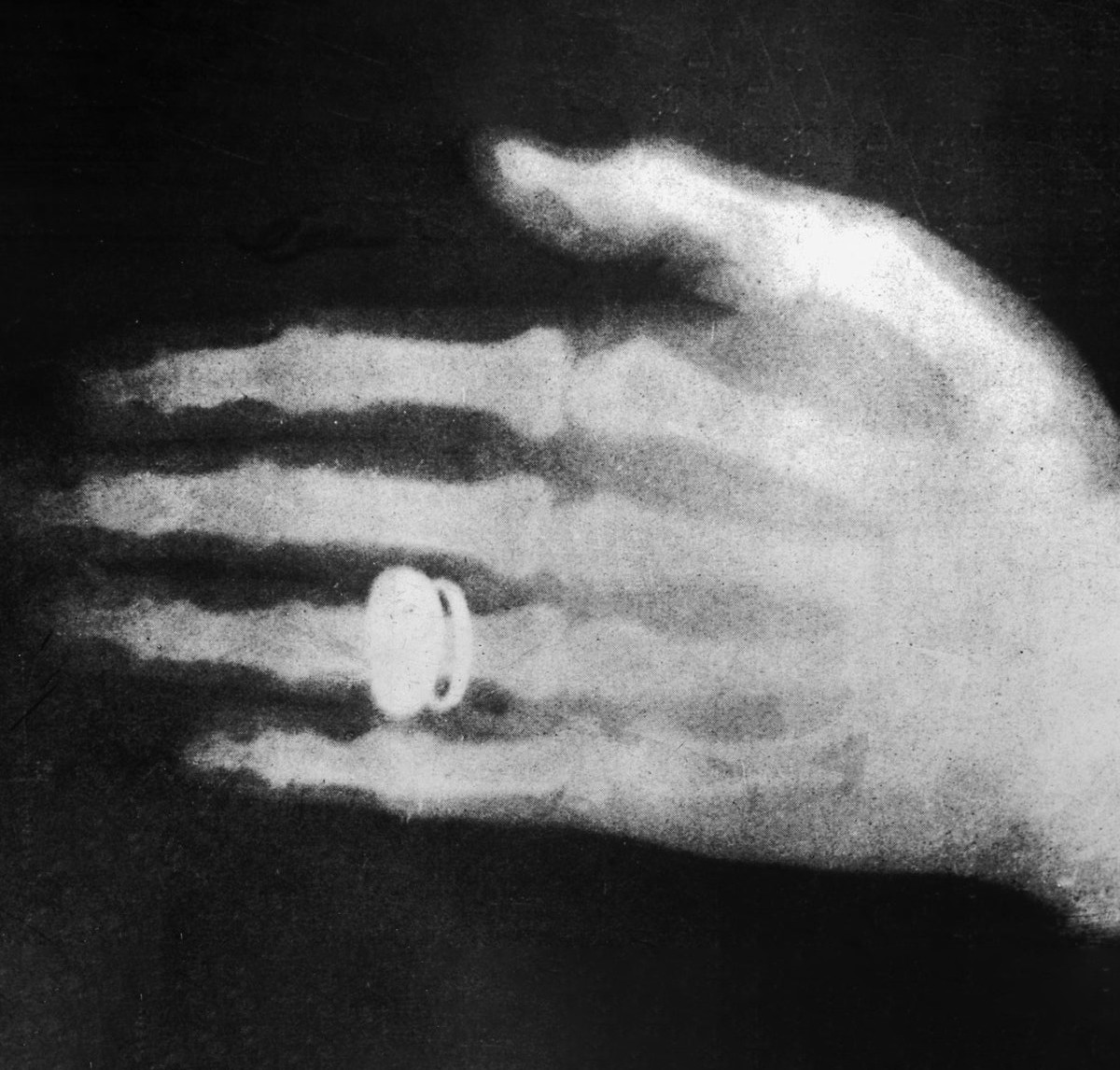 First Ever X-ray | Attention Deficit Disorder Prosthetic Memory Program